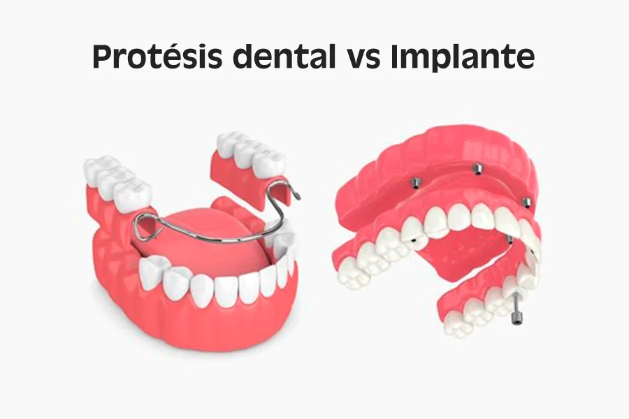 ¿Qué es Mejor: Una Prótesis dental o un Implante ? - Doctor Hugo Quezada